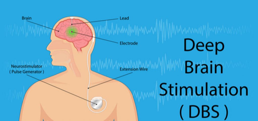 Deep Brain Stimulation (DBS) - Dr. Hrishikesh Chakrabartty